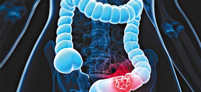 Περί καρκίνου του παχέος εντέρου: Οι σύγχρονοι τρόποι αντιμετώπισης ...